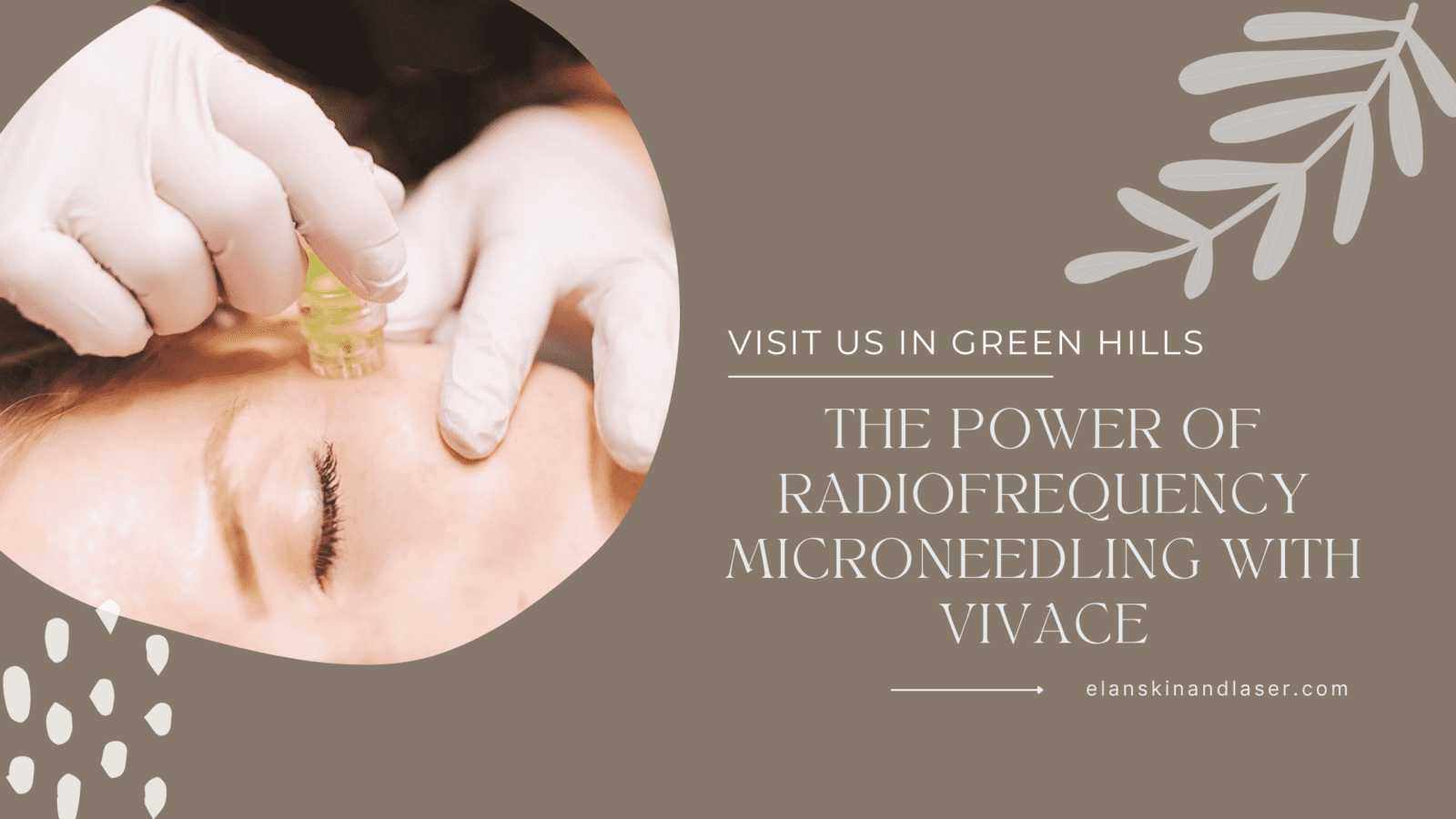 Experience the Power of Radiofrequency Microneedling with Vivace at ...